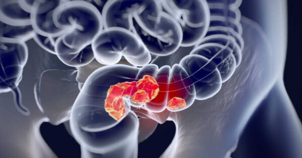 Cáncer de colon – GNC Farmácia